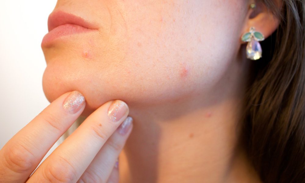 Tips to get rid of winter acne